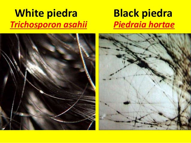 Fungal infections prenav