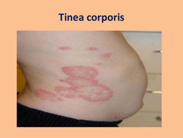 Fungal infections prenav