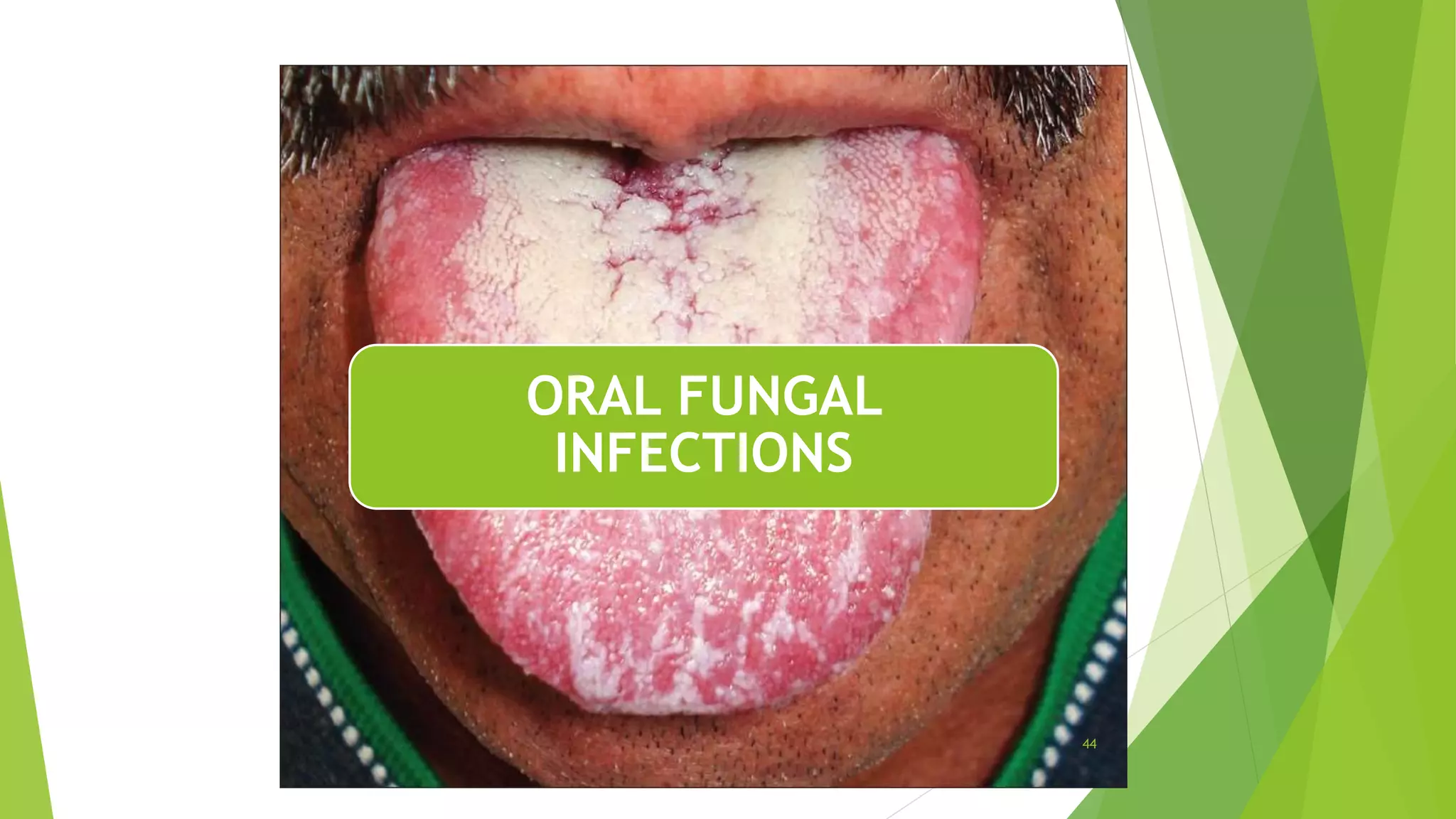 FUNGAL INFECTIONS OF ORAL CAVITY | PPTX | Dental Health | Diseases and ...