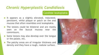 FUNGAL INFECTIONS OF ORAL CAVITY | PPTX