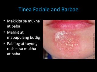 Fungal infections sa balat | PPT