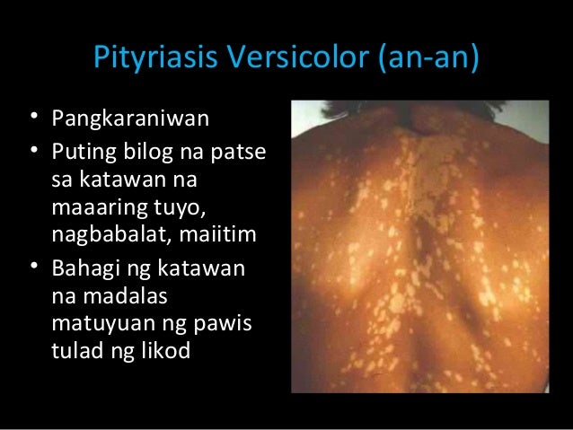Fungal infections sa balat