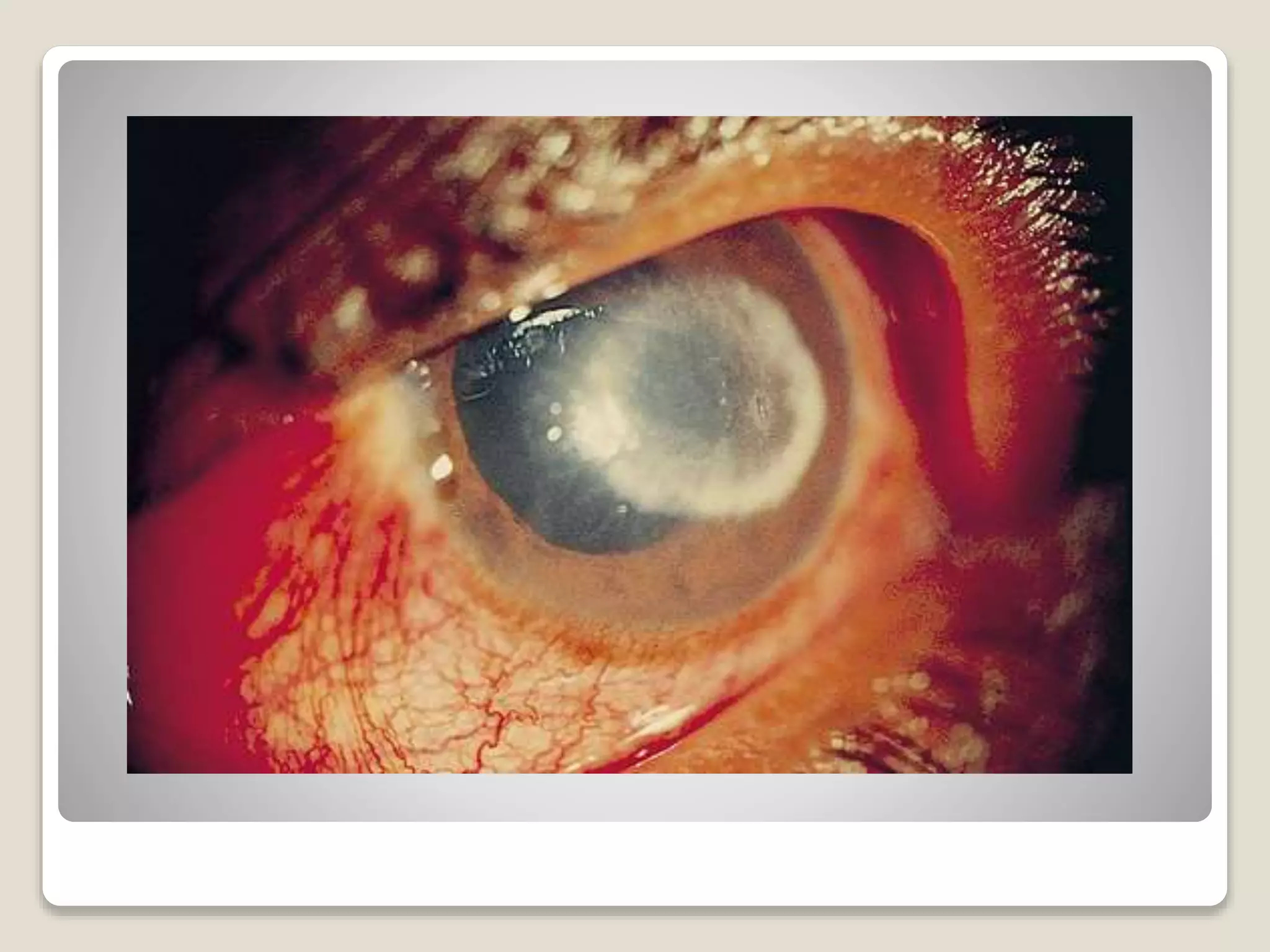 Fungal keratitis | PPT