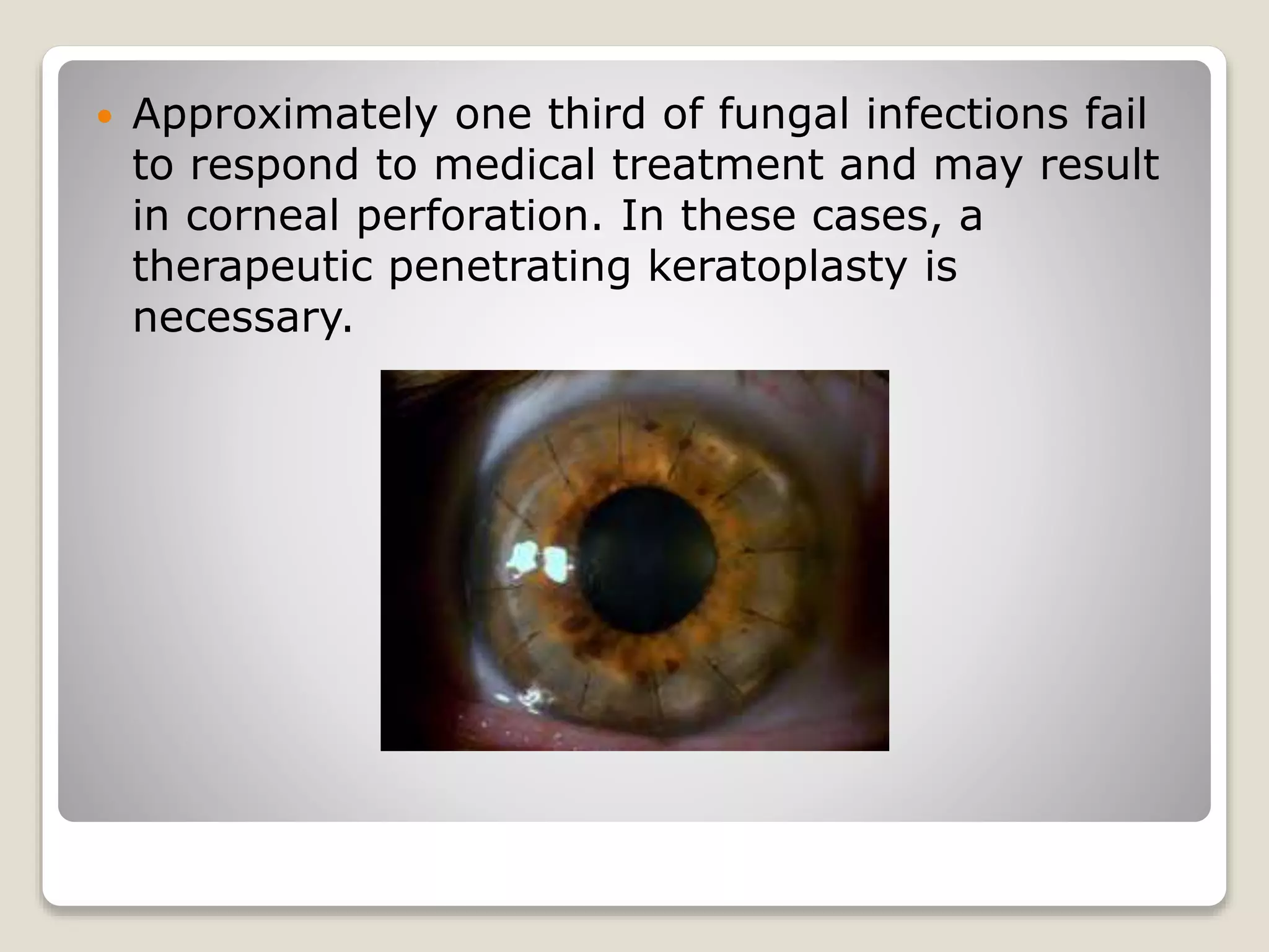 Fungal keratitis | PPT