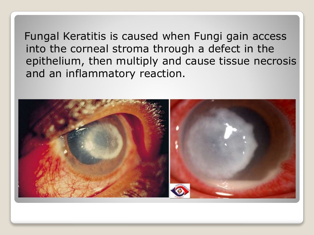 Fungal keratitis