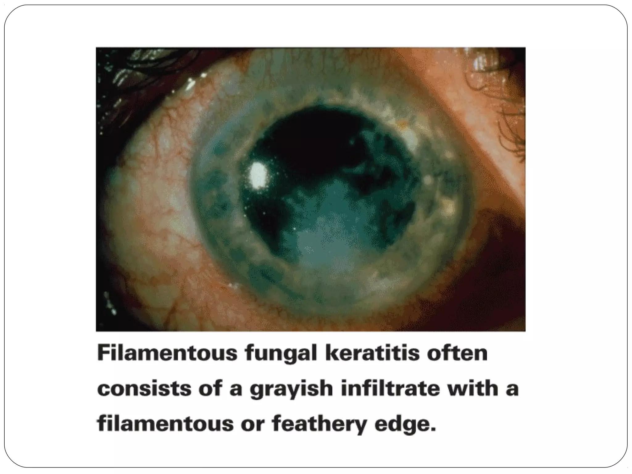 Fungal keratitis | PPT