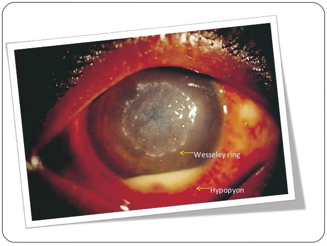 Fungal keratitis