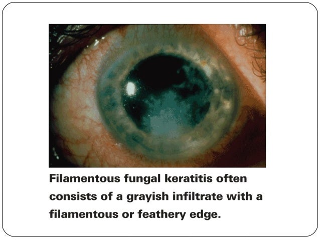 Fungal keratitis