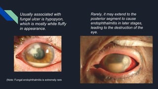 Fungal Keratitis With Hypopyon