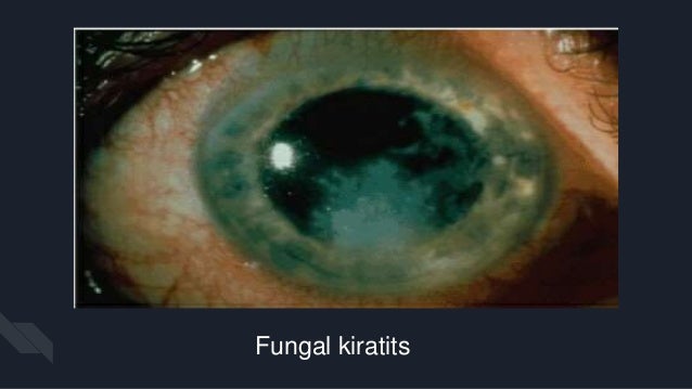 Fungal keratitis