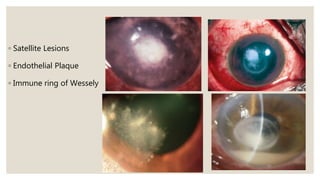Fungal keratitis | PPTX