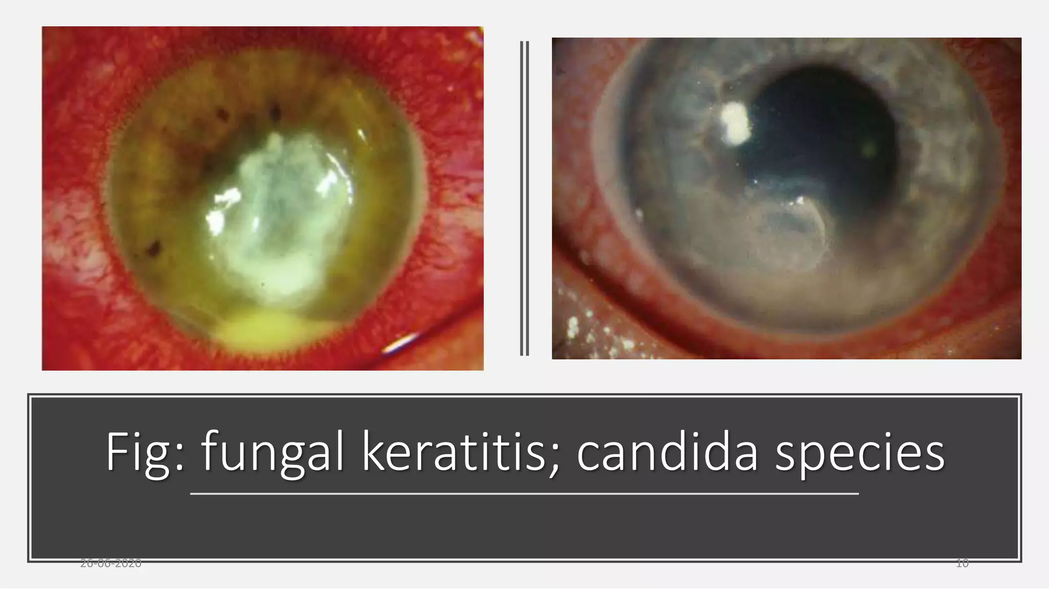 Fungal keratitis | PPTX