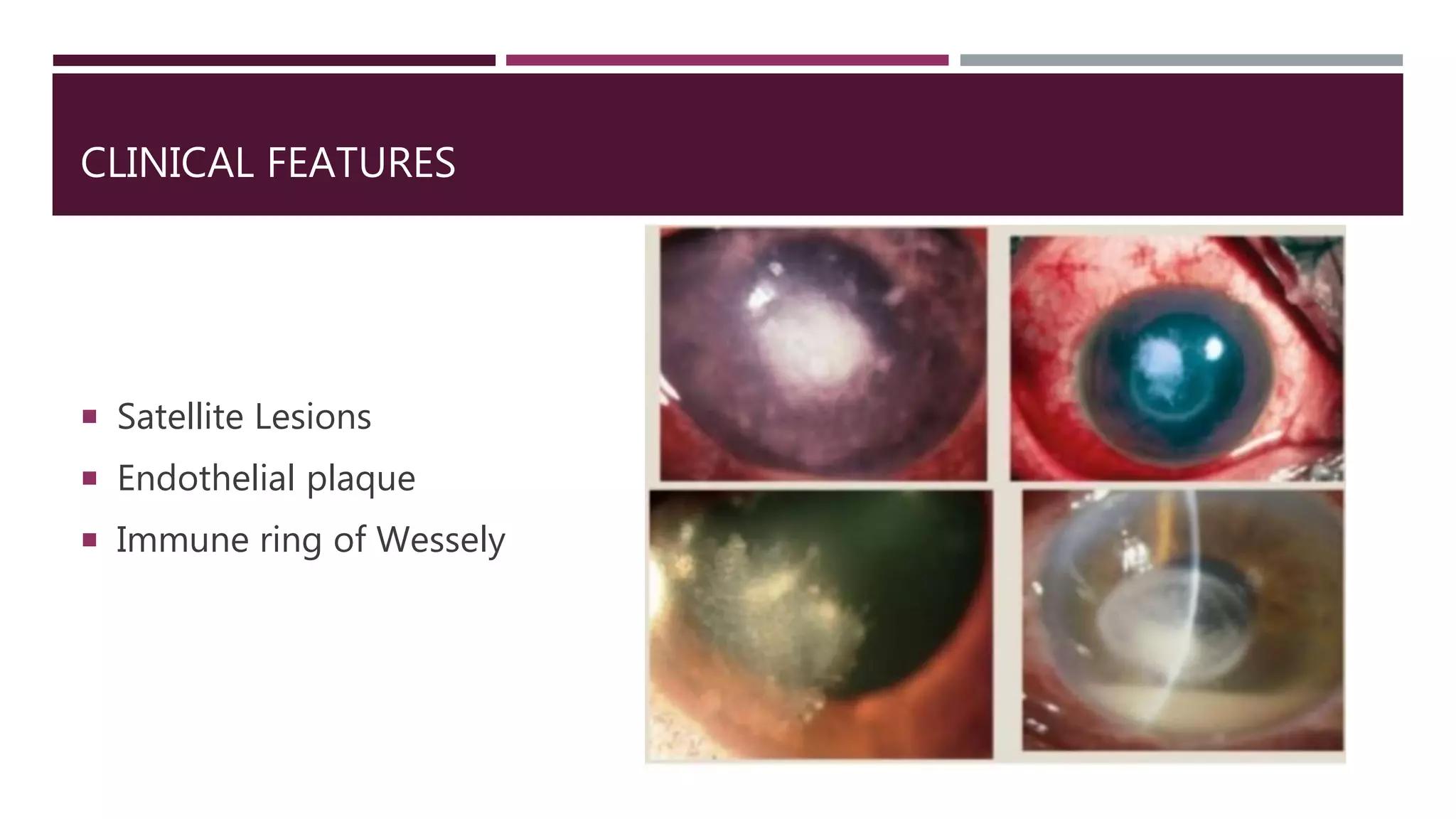 Fungal keratitis | PPTX