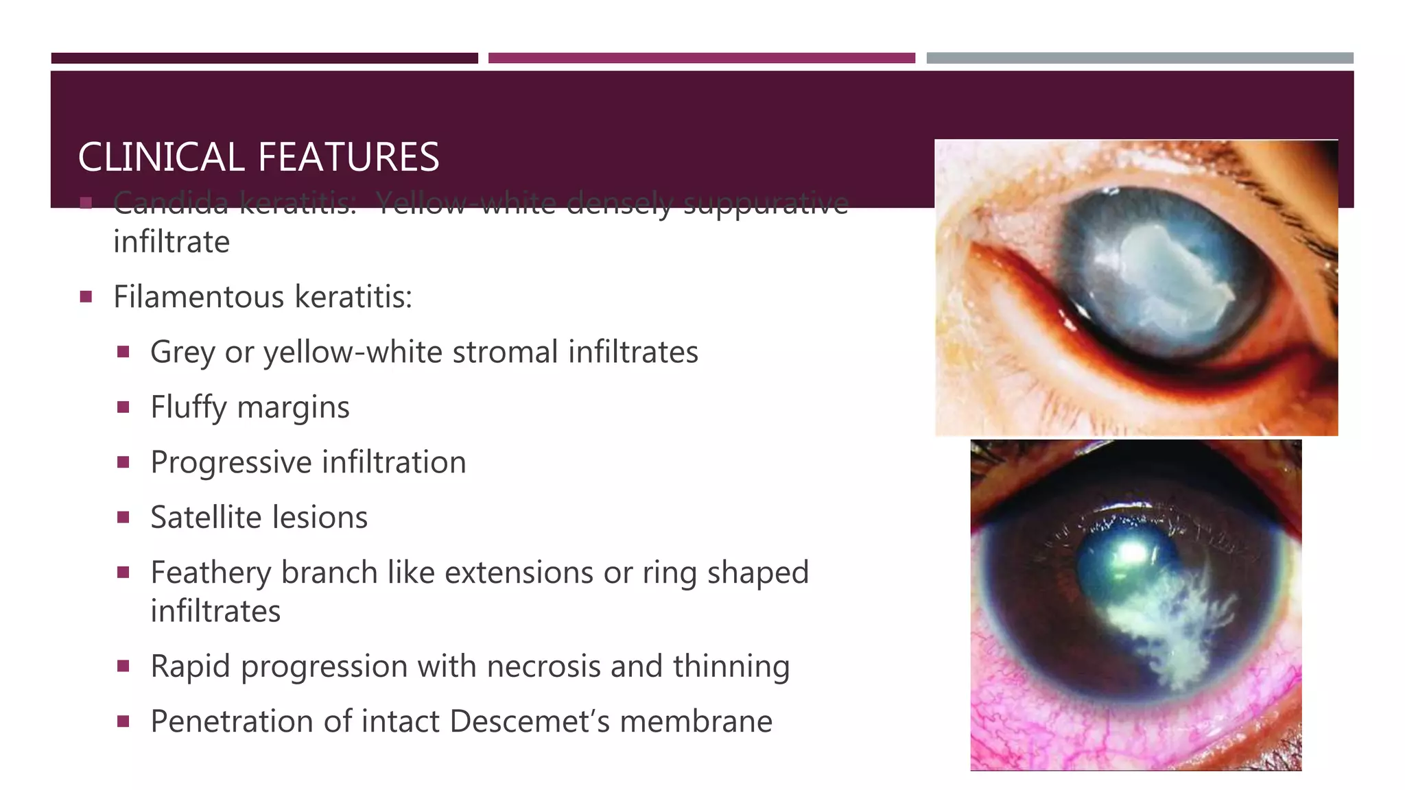 Fungal keratitis | PPTX | Eye and Vision Conditions | Diseases and ...