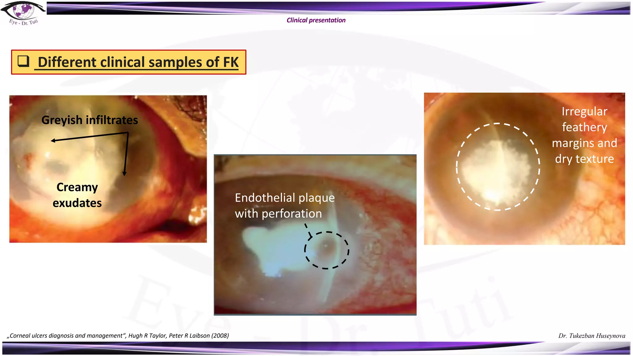 Fungal Keratitis.pdf