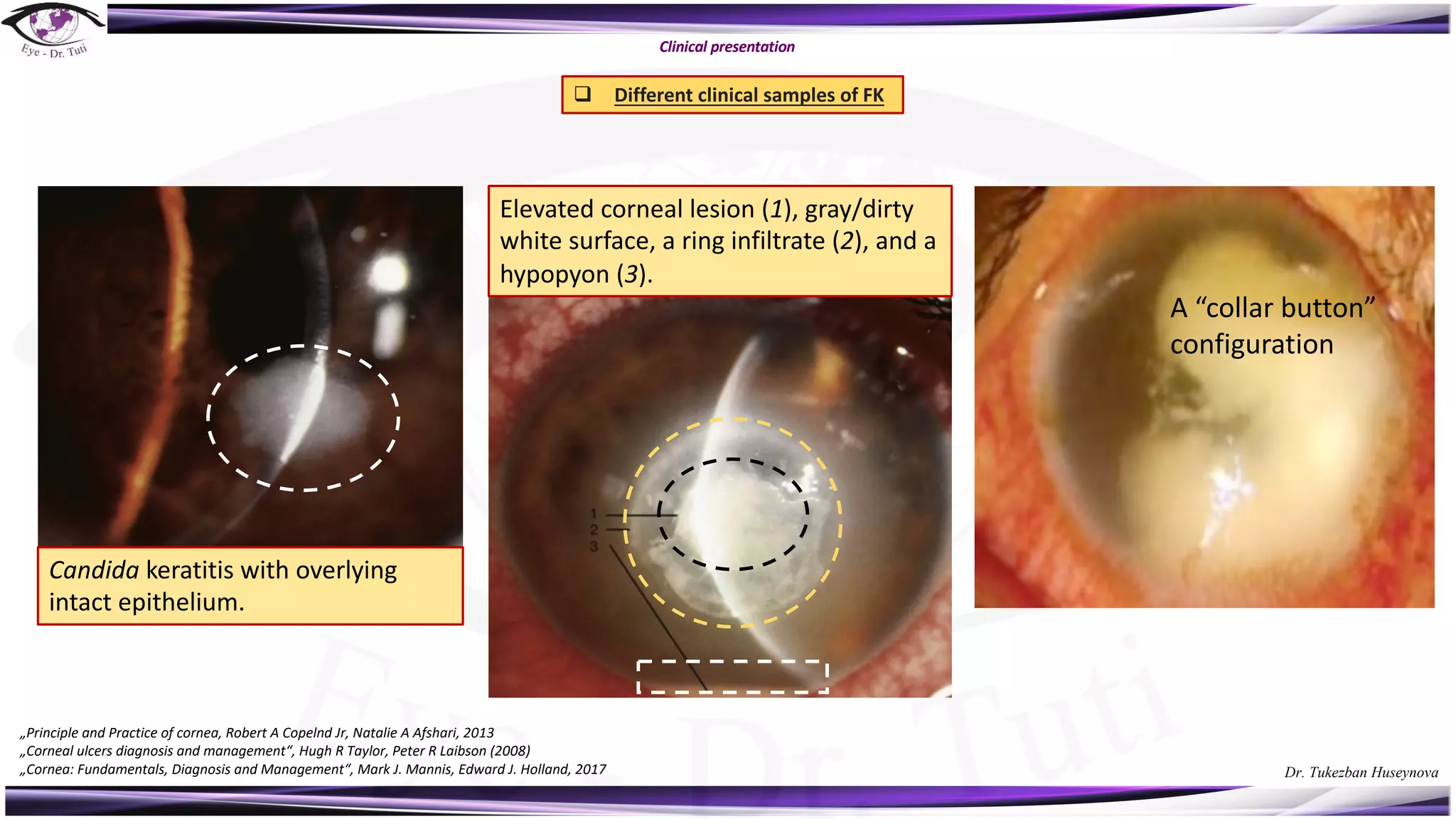 Fungal Keratitis.pdf