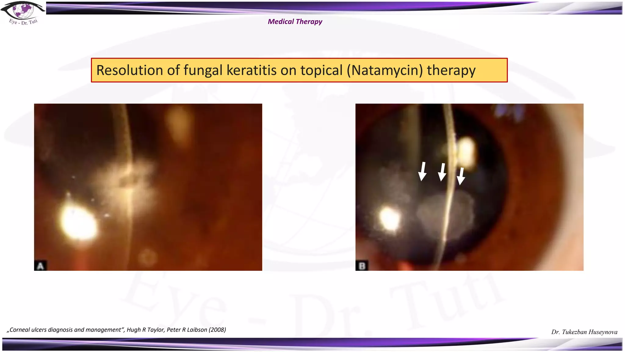 Fungal Keratitis.pdf