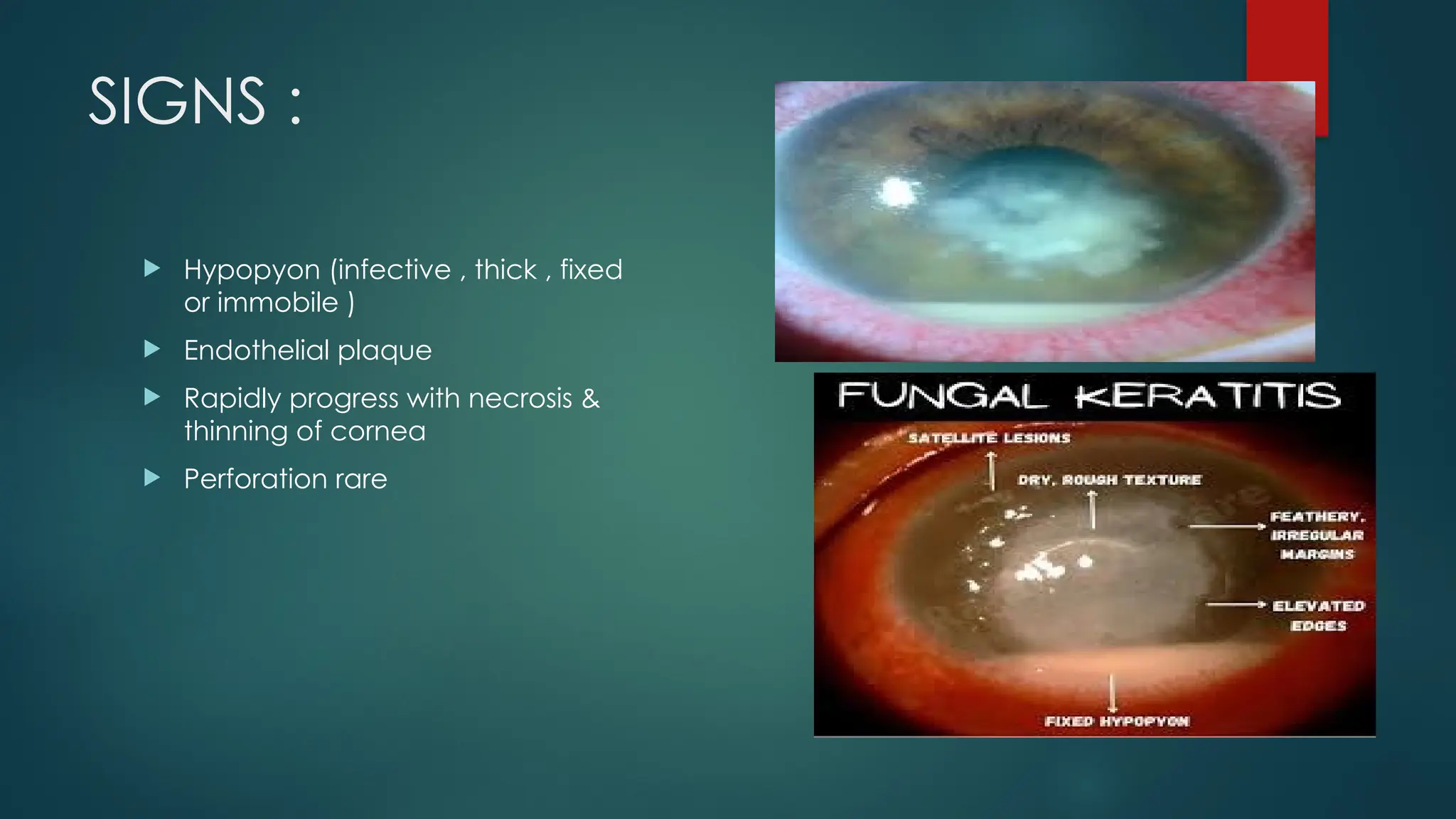 Fungal keratitis - etiology, pathogenesis, diagnosis and management.pptx