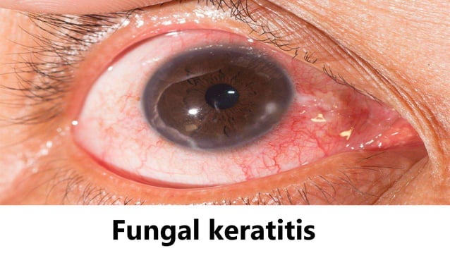 Fungal keratitis(1).pptx ocular Microbiology | PPTX | Eye and Vision ...