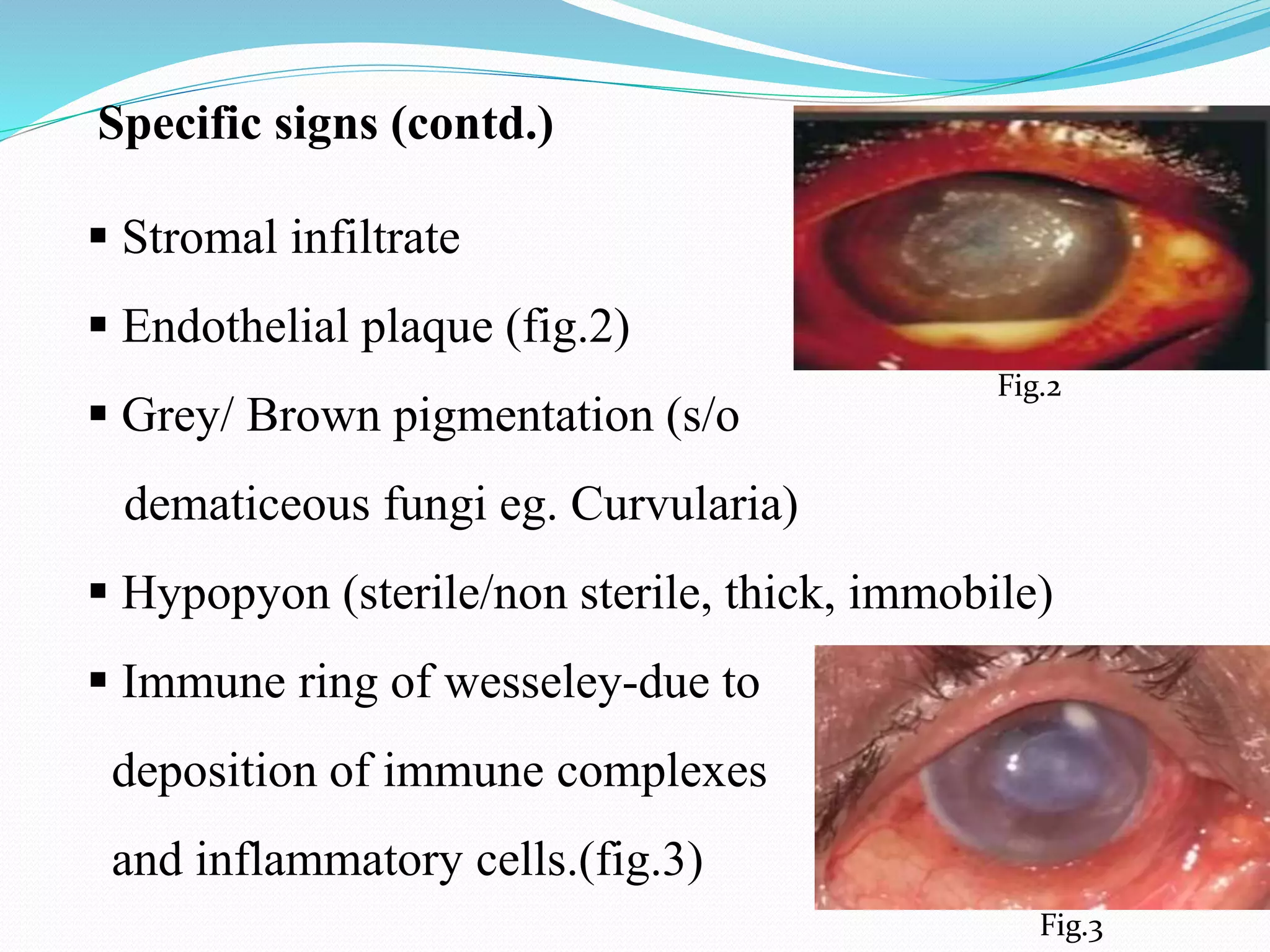 Fungal keratitis | PPTX
