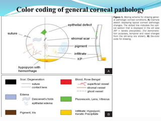 Fungal keratitis | PPT
