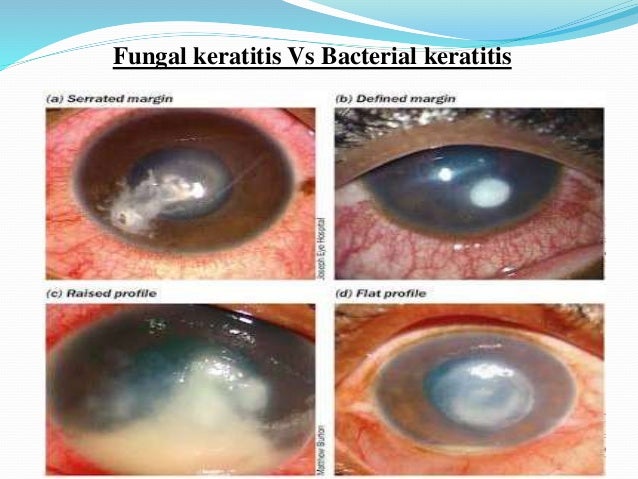 Fungal keratitis
