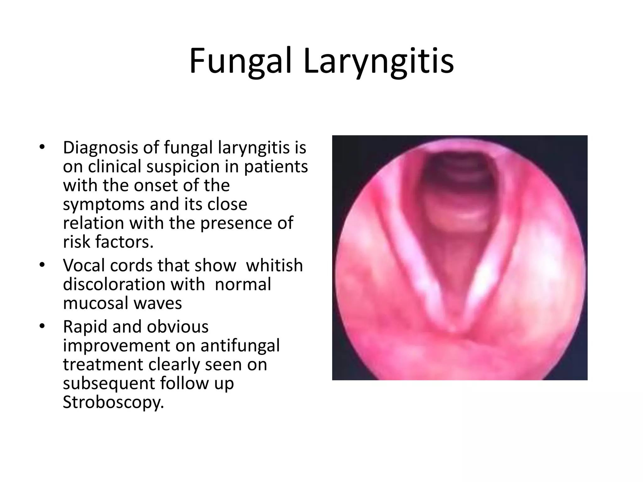 Fungal laryngitis | PPTX