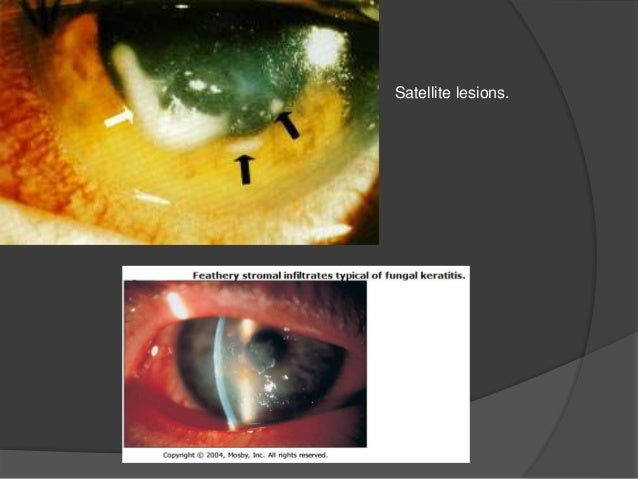Images Eye Infections Fungal Mycosis Ocular Mycotic Infections Ocular ...