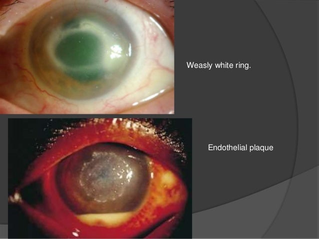 Images Eye Infections Fungal Mycosis Ocular Mycotic Infections Ocular ...