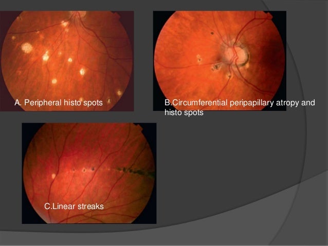 Fungal lesions of the eye