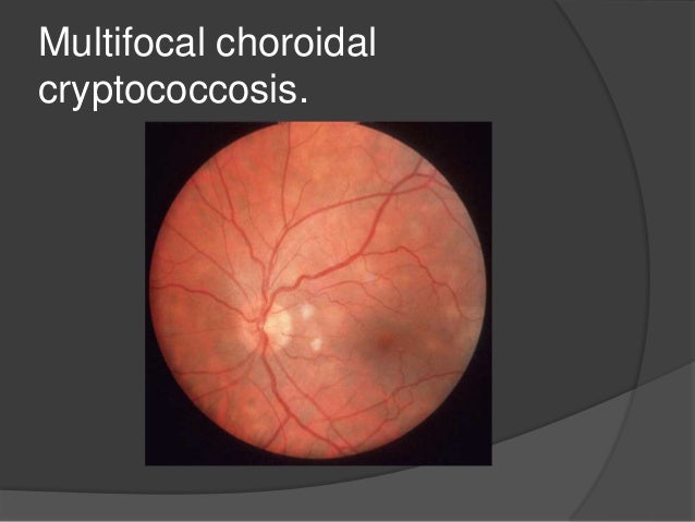 Fungal lesions of the eye
