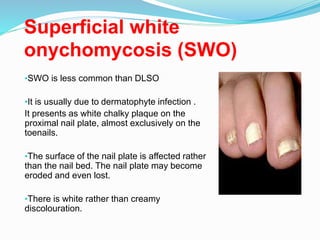 Nails Fungal infections | PPTX | Foot Health | Diseases and Conditions