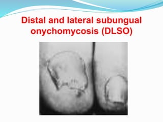 Nails Fungal infections | PPTX