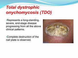 Total Dystrophic Onychomycosis