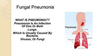 Fungal pneumoia | PPTX