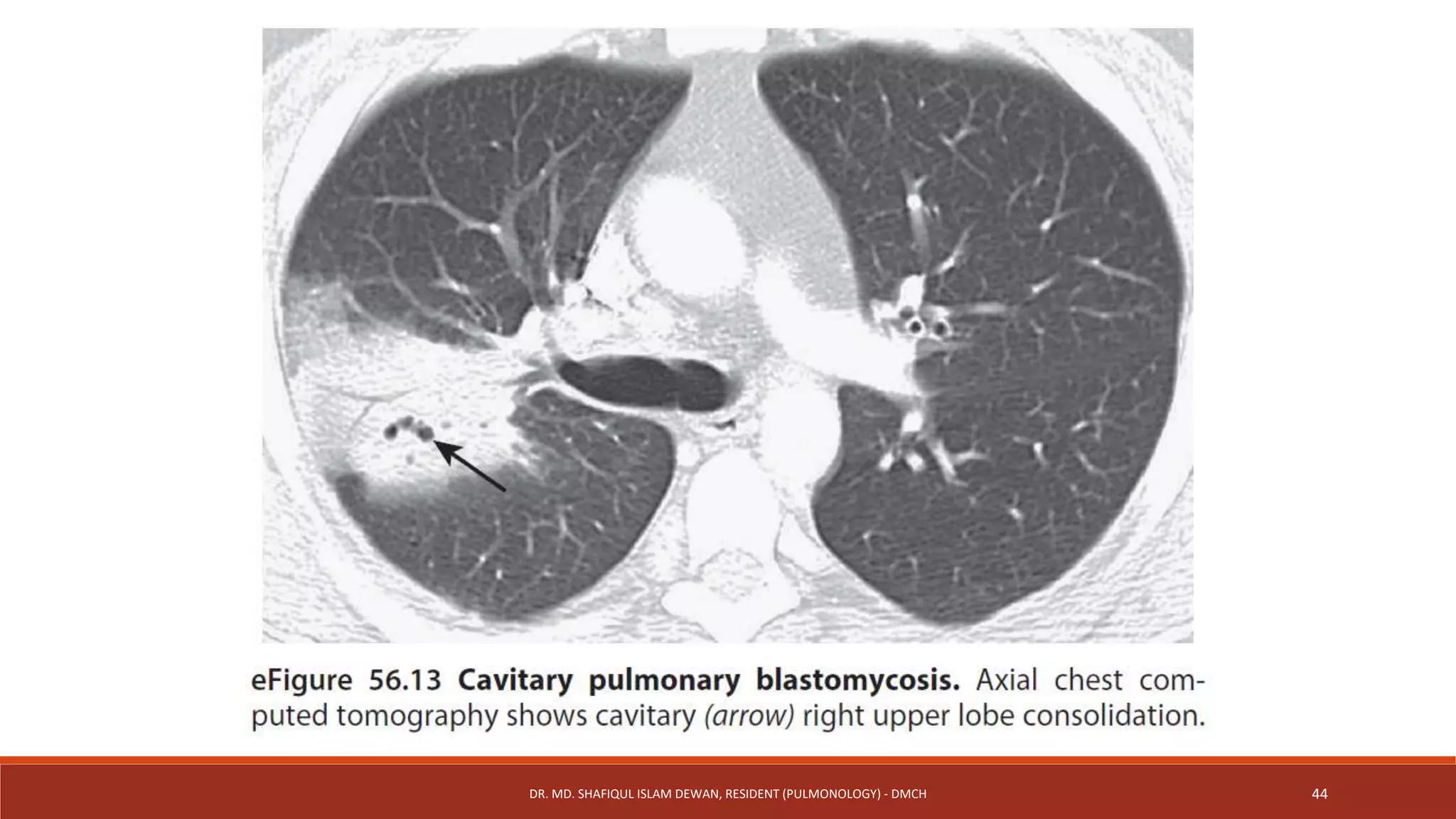 Fungal Pneumonia.pptx