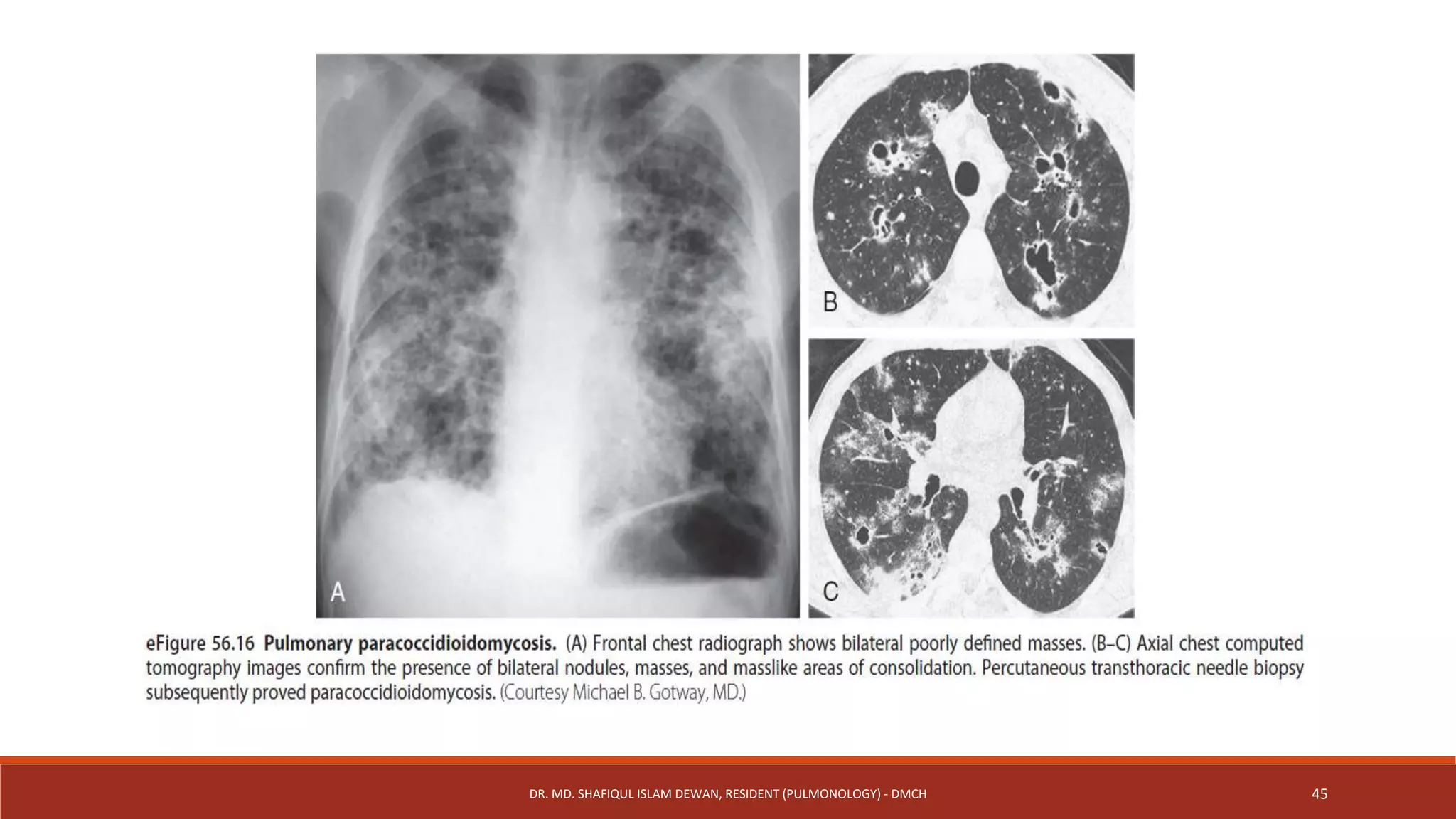 Fungal Pneumonia.pptx