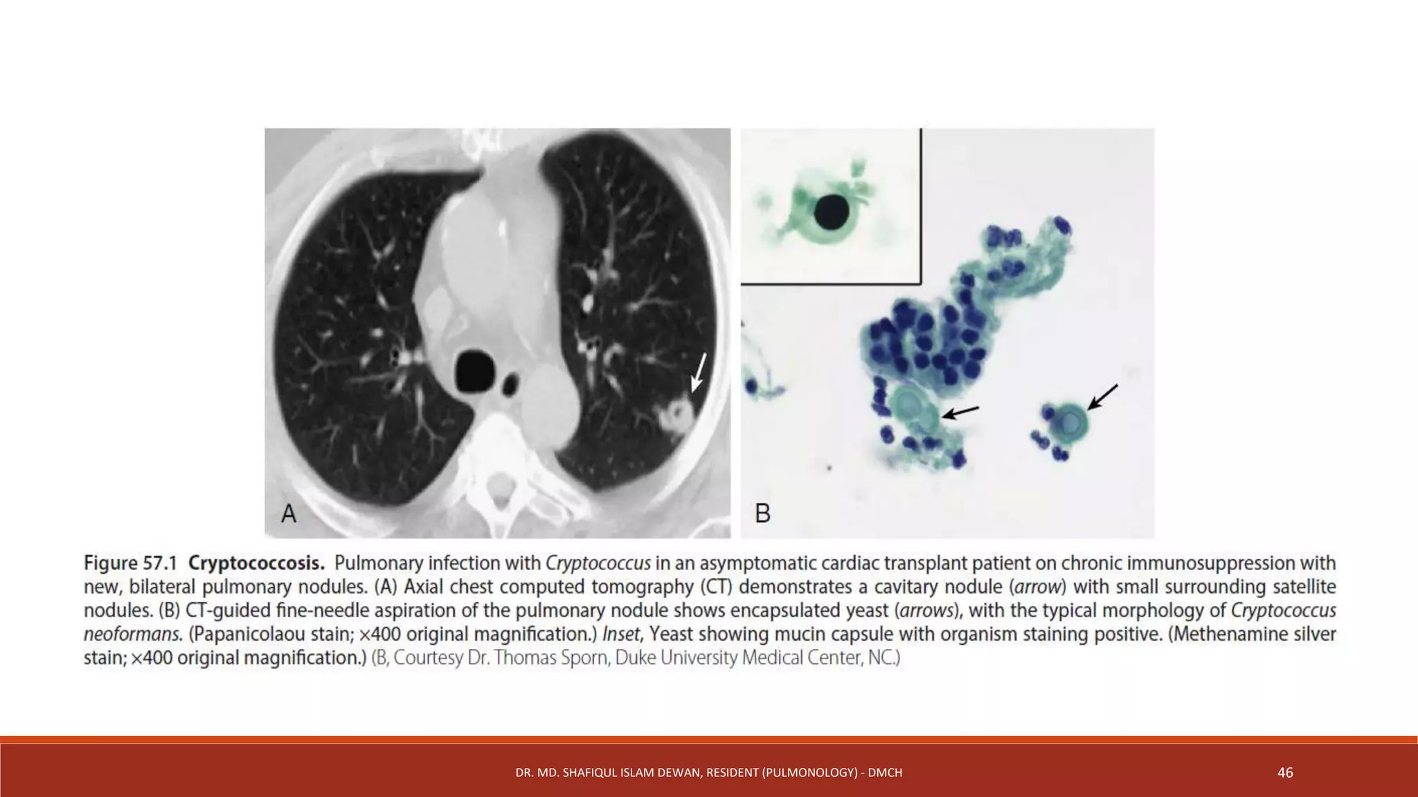 Fungal Pneumonia.pptx