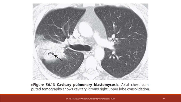 Fungal Pneumonia.pptx