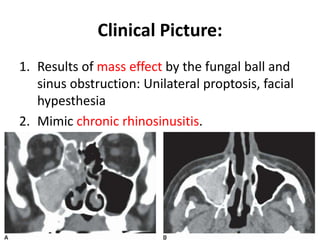 Fungal Rhino-sinusitis.pptx