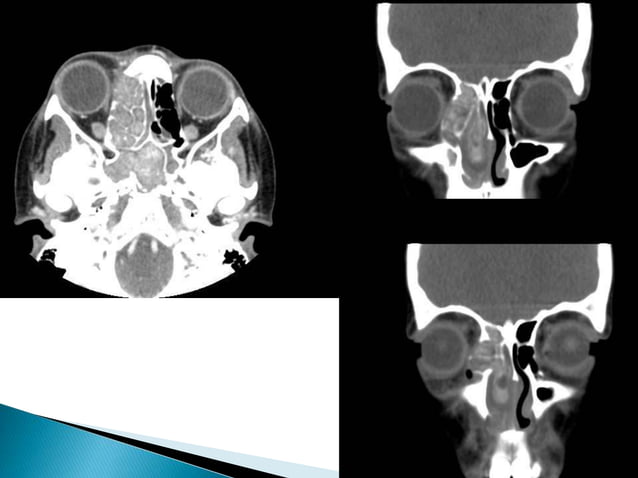Fungal rhinosinusitis | PPT