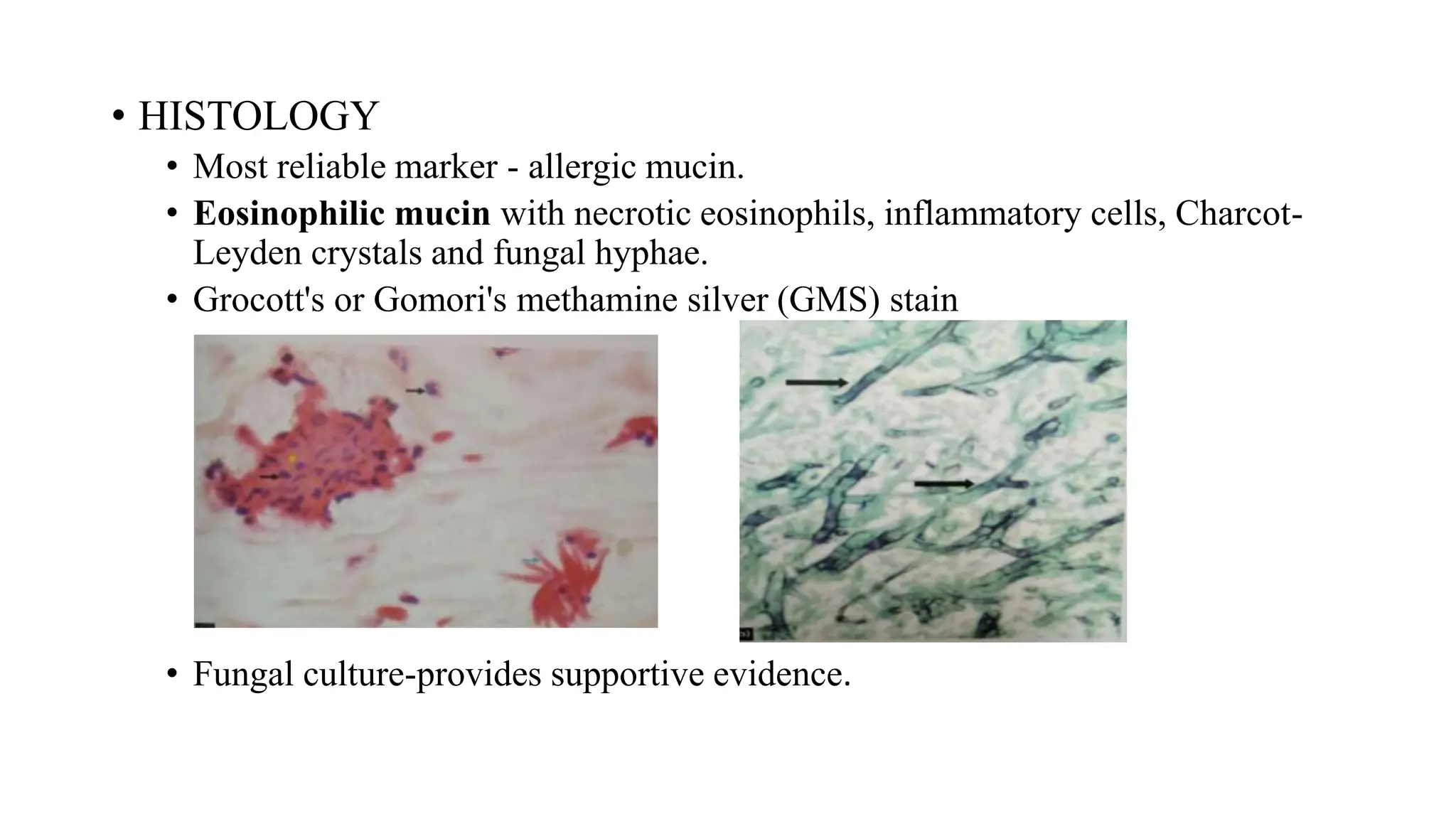 FUNGAL RHINOSINUSITIS - invasive fungal sinusitis.pptx