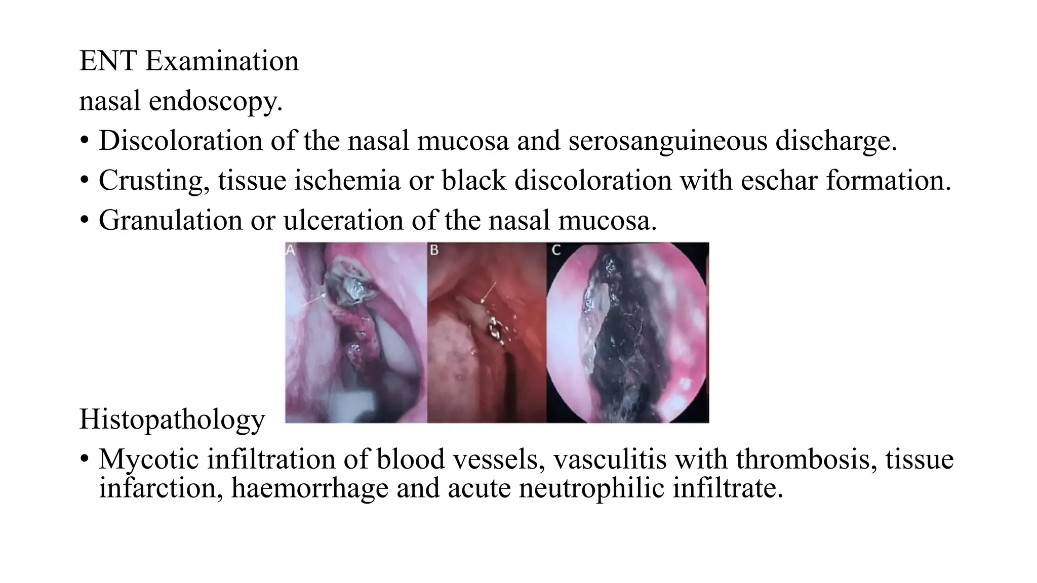 FUNGAL RHINOSINUSITIS - invasive fungal sinusitis.pptx