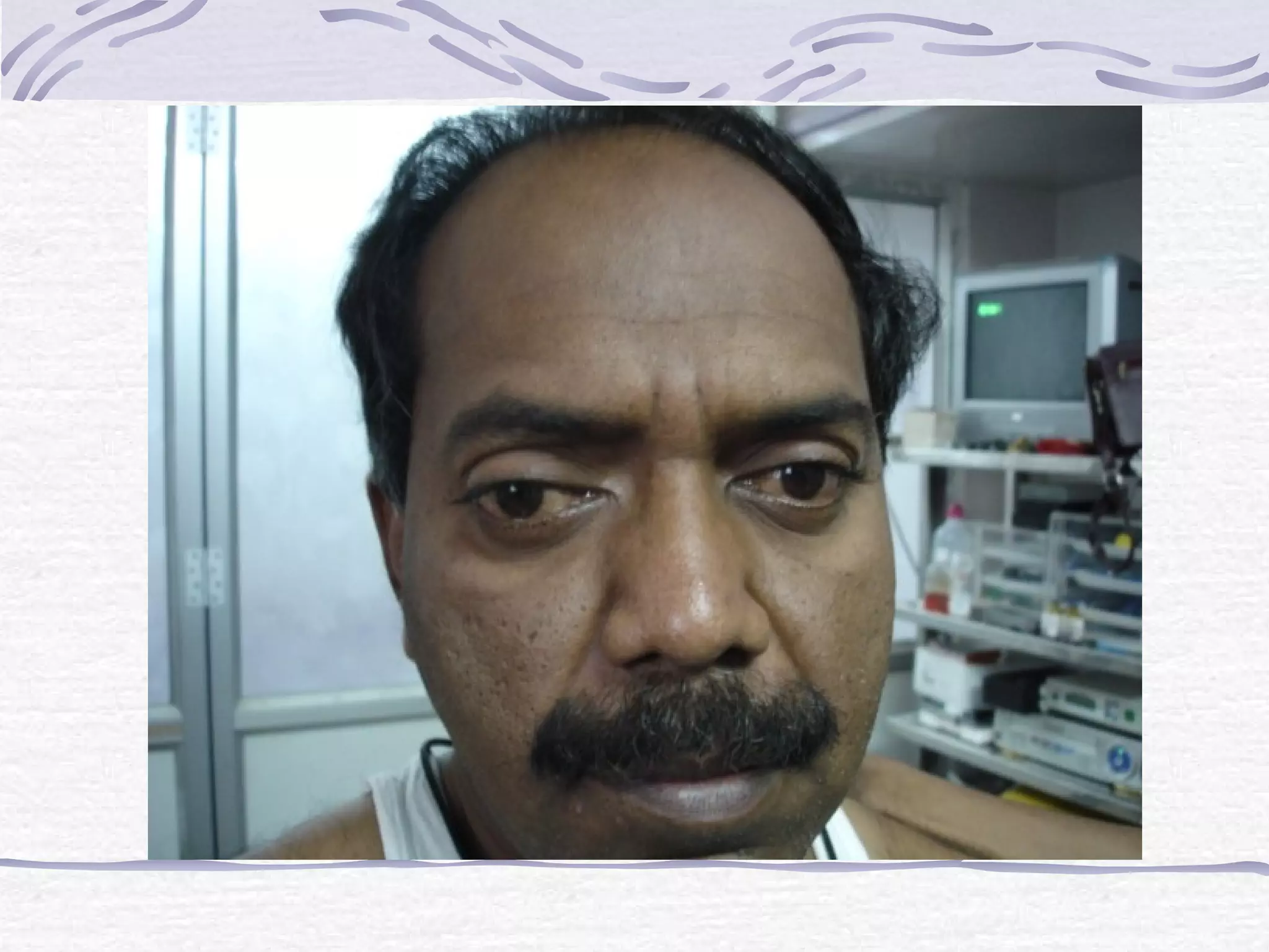 Allergic Fungal Rhinosinusitis | PPT