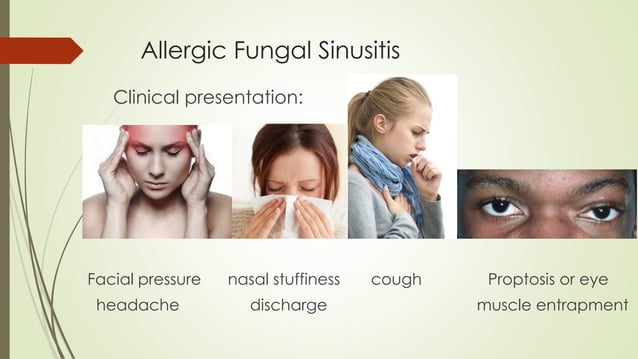 Fungal sinusitis | PPT