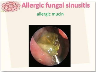 Fungal sinusitis | PPTX