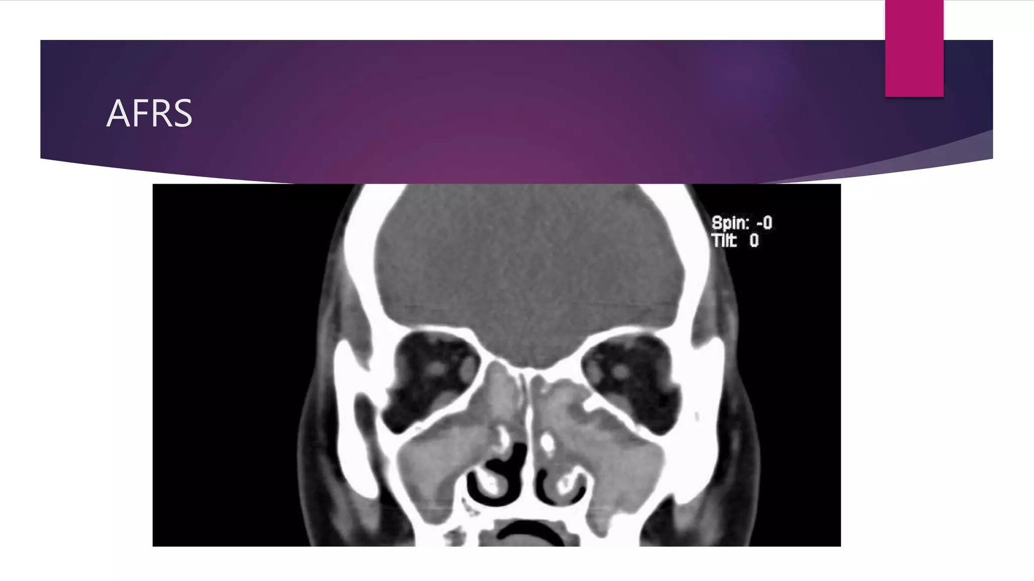 Fungal sinusitis.pptx