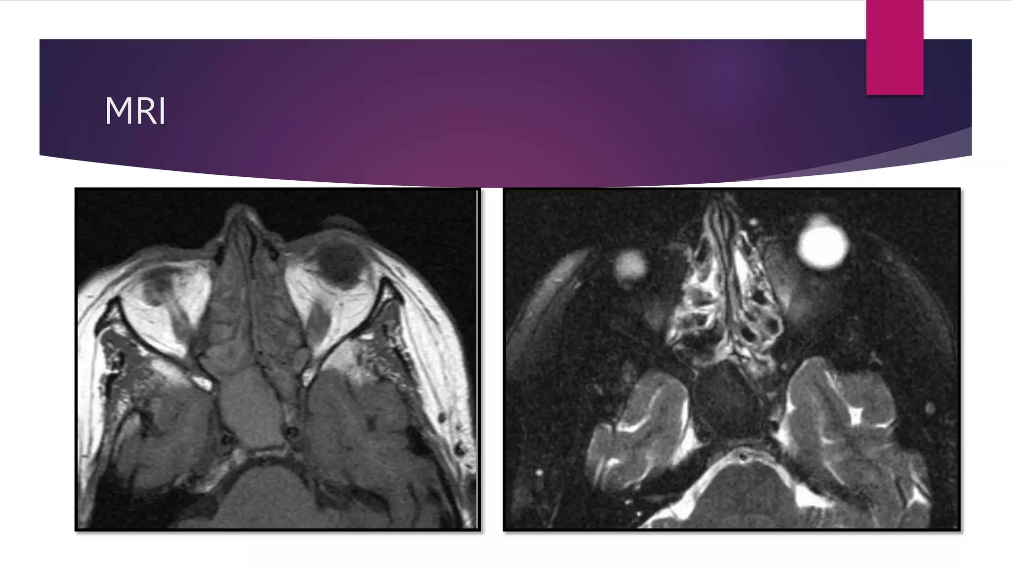 Fungal sinusitis.pptx