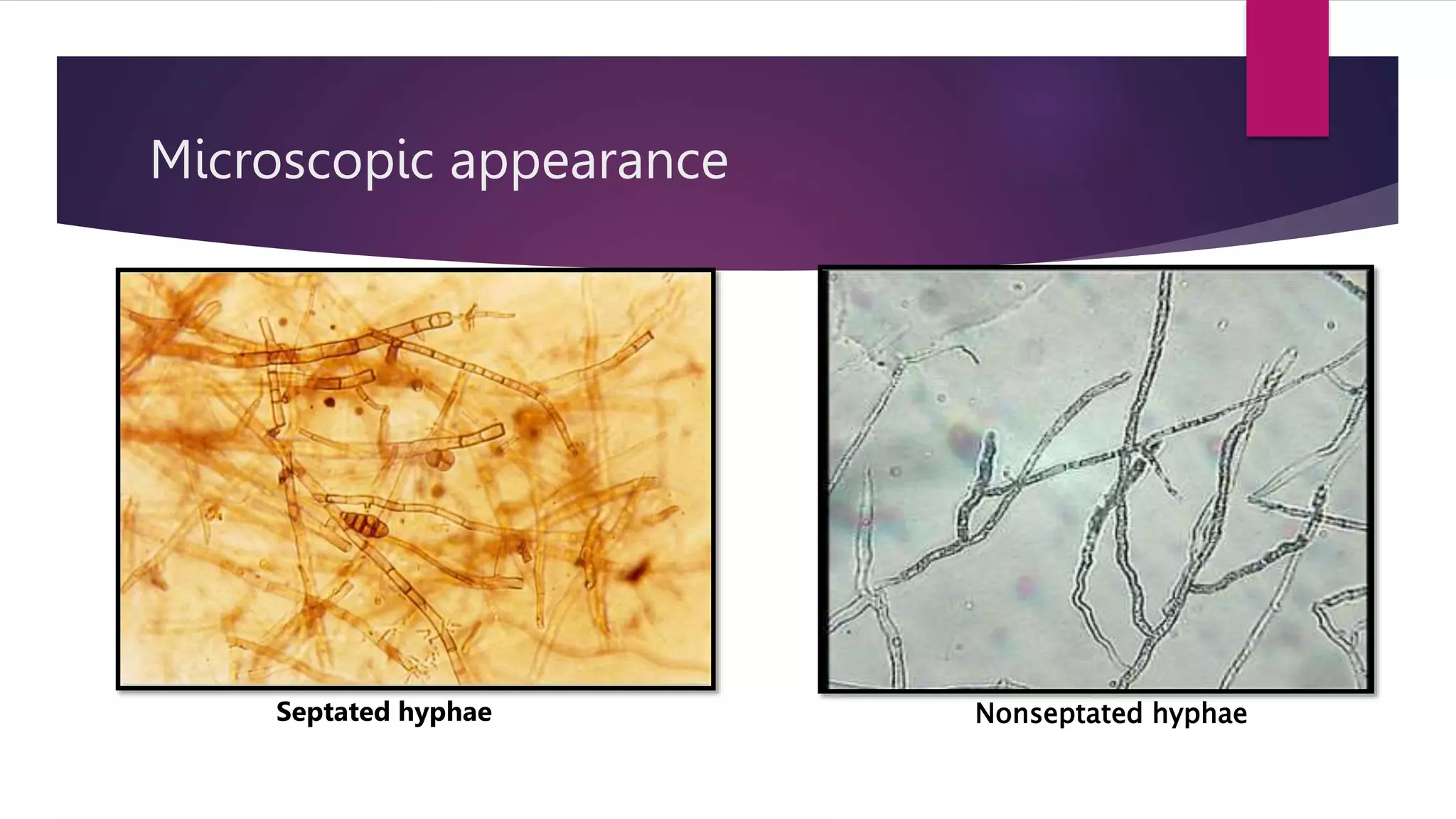 Fungal sinusitis.pptx