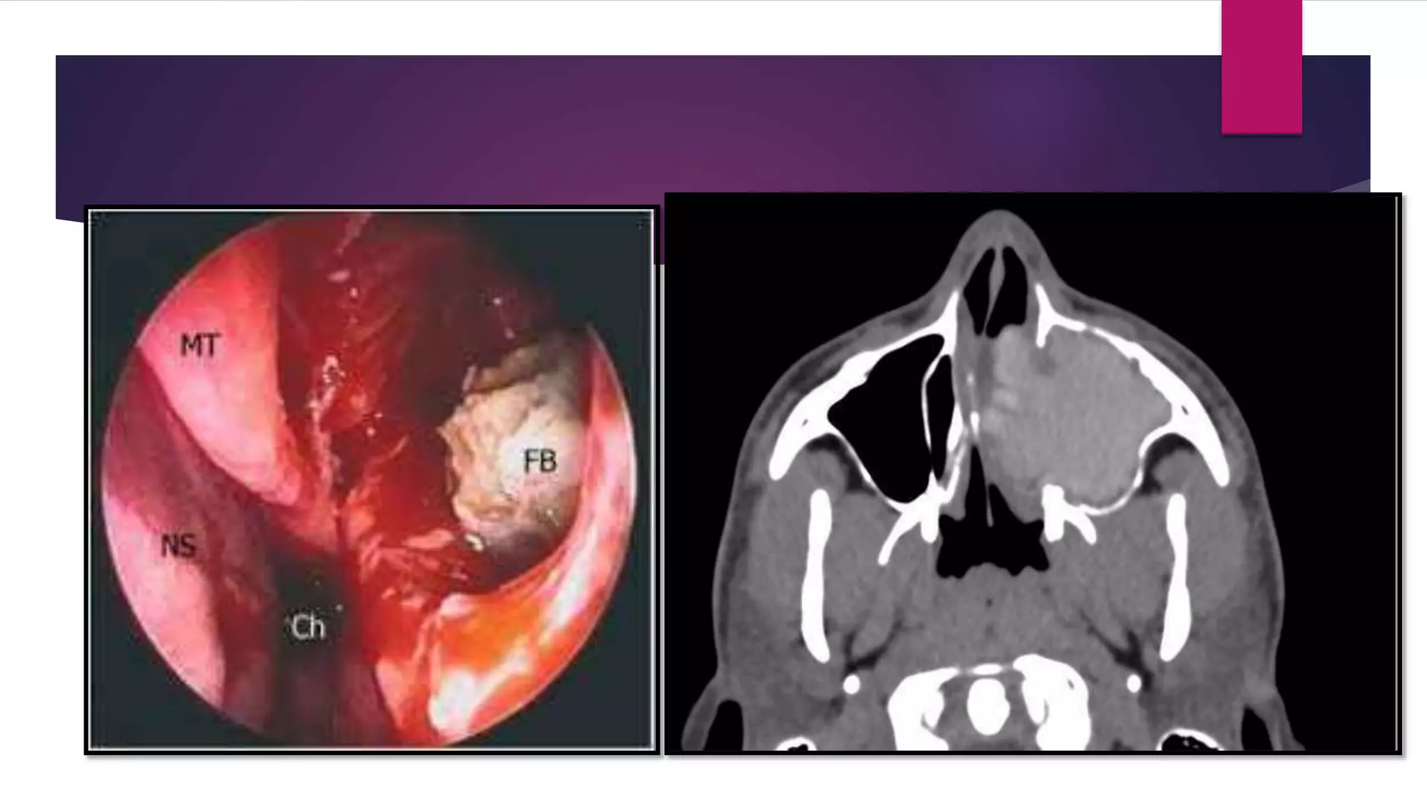 Fungal sinusitis.pptx